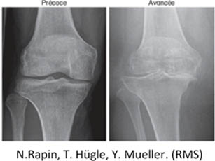 Principaux troubles fonctionnels Membre inf – up-ostéo.net
