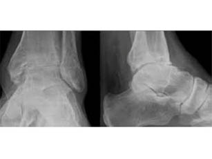 Principaux troubles fonctionnels Cheville-pied – up-ostéo.net